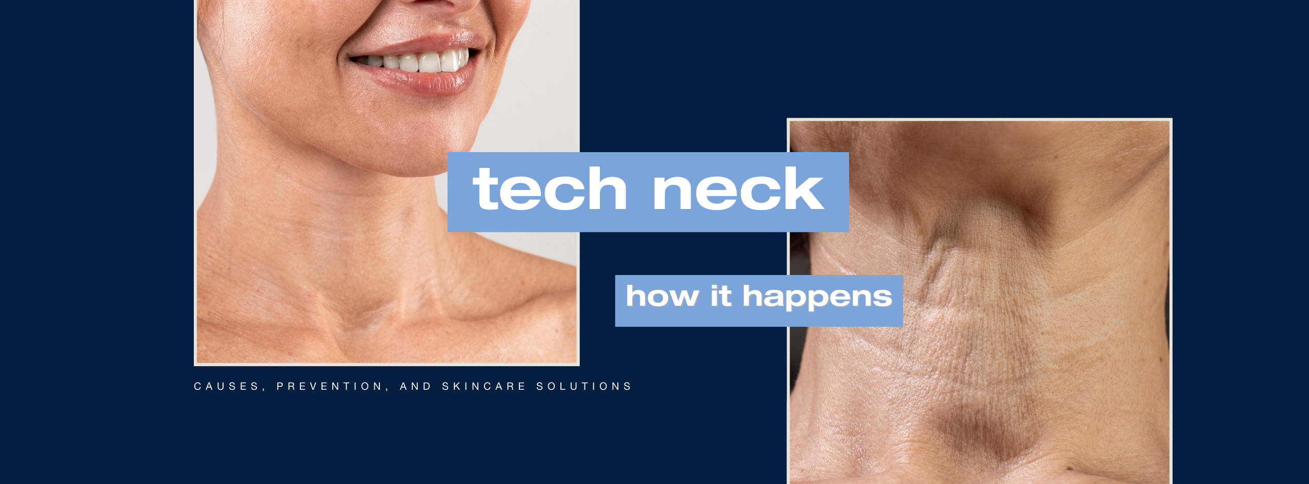 skoah | Tech Neck Explained: Causes, Prevention, and Skincare Solutions